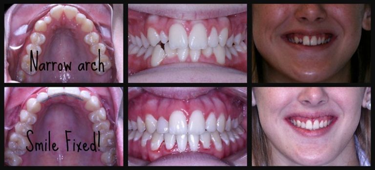 Before & Afters | Orthodontist Pearland TX | Braces Bellaire TX